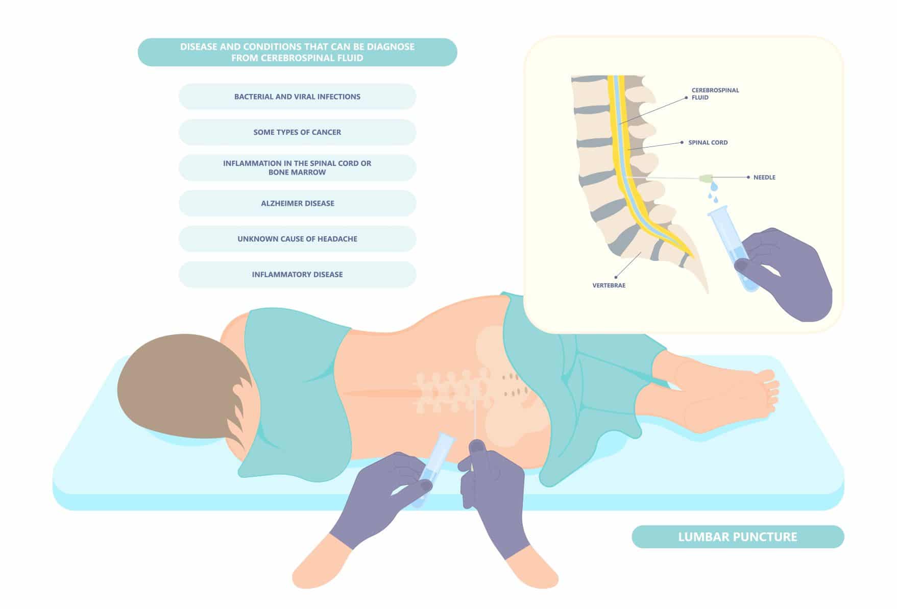 PASS (Point-Assisted Spinal Sonography), an ultrasound-guided lumbar ...