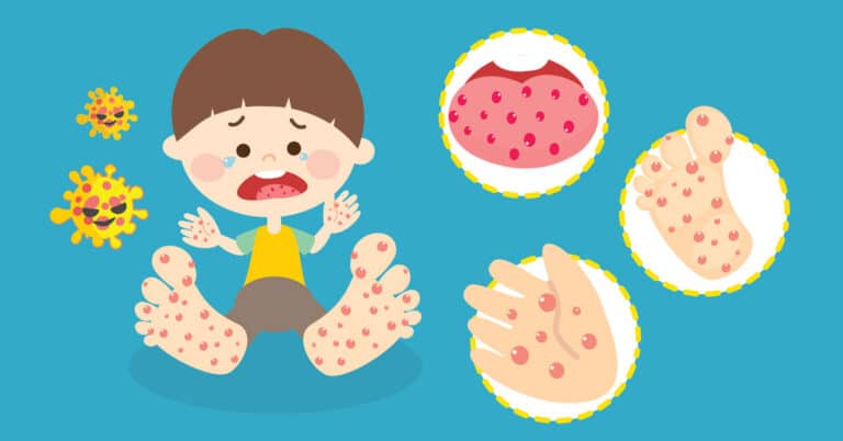 Thailand Must Prepare for More Dangerous EV-A71 HFMD Virus, Warns Chula ...