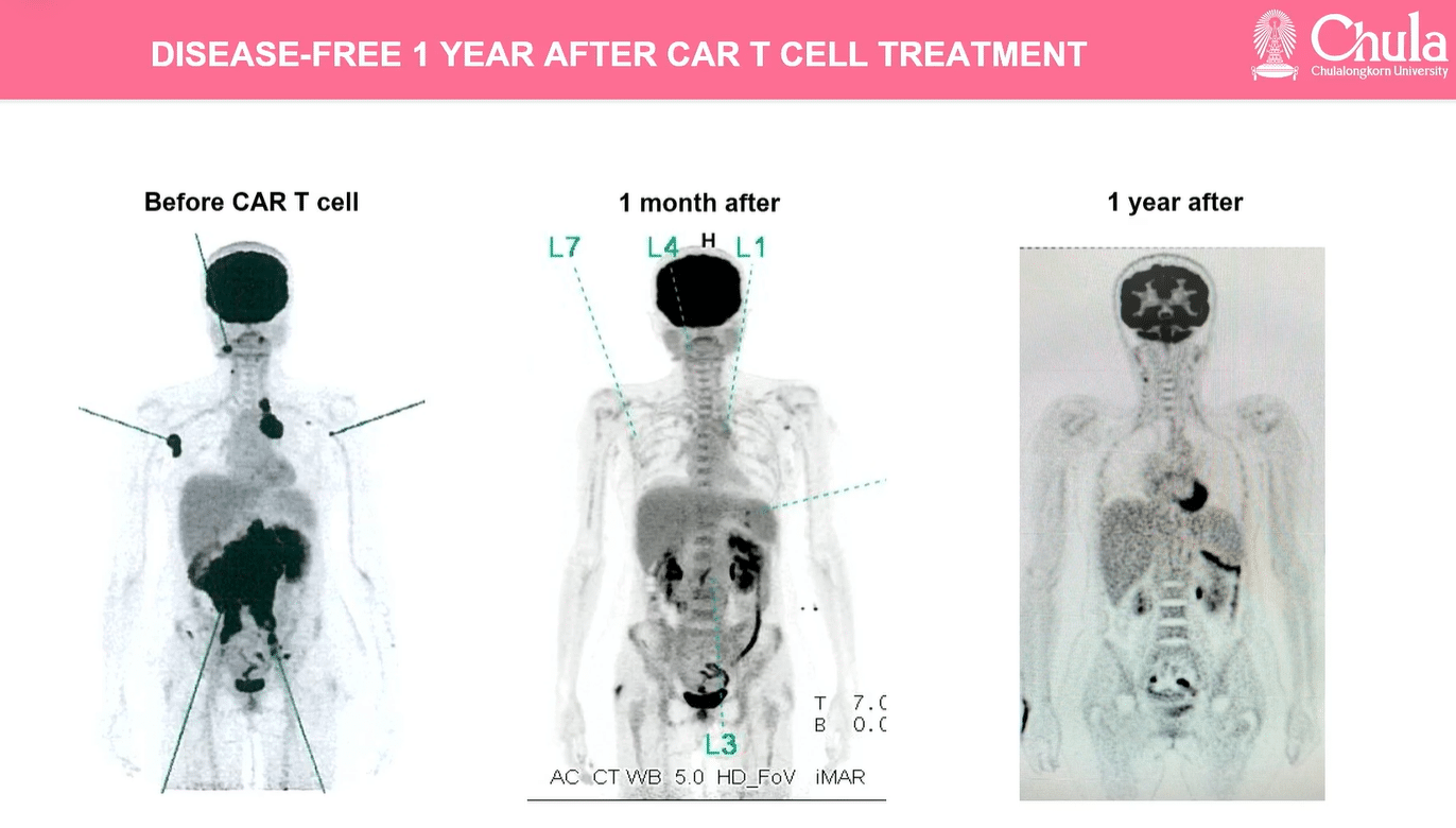 Chula Makes Progress in “CAR T-Cell Therapy” Innovation – Chulalongkorn ...