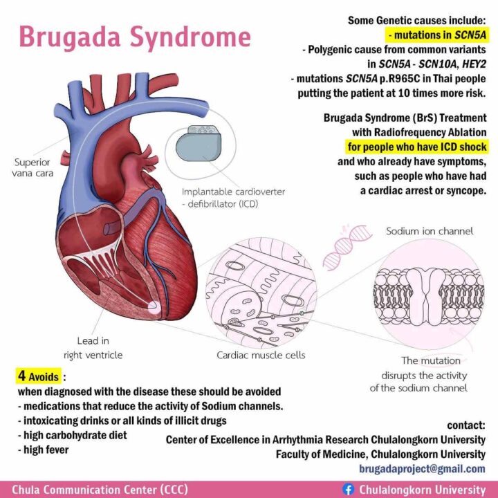 “Brugada Syndrome” A Silent and Deadly Threat to Thai Men ...